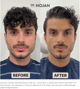 Botox - Dr Nojan Bakhtiari: TMJ, Oral and Facial Pain Specialist